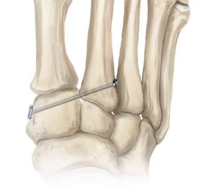 Foot & Ankle_Arthrex_PRODUCTS_ - Joinsmart Biomedical Co., Ltd.