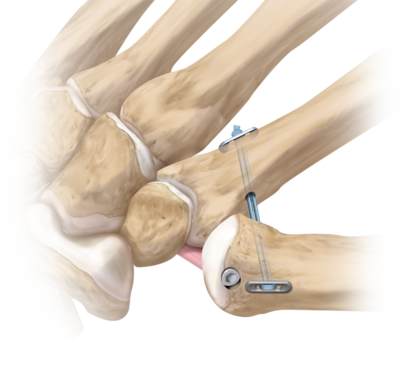 Hand & Wrist_Arthrex_PRODUCTS_ - Joinsmart Biomedical Co., Ltd.