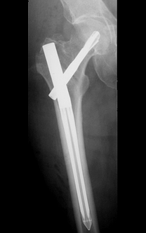 Fixion Nail_Carbofix_PRODUCTS_ - Joinsmart Biomedical Co., Ltd.